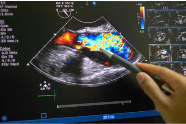 Transthoracic Echocardiogram (TTE): Procedure, Uses, & Cost - Portable ...